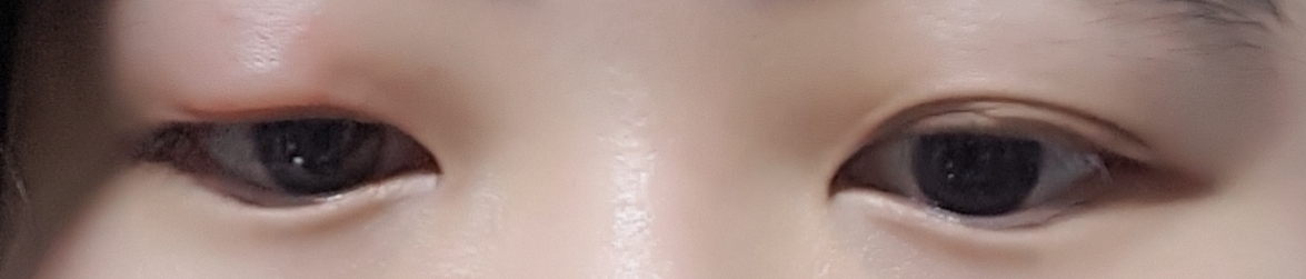 뭐에 물렸나? 눈이 부었어ㅋㅋ
